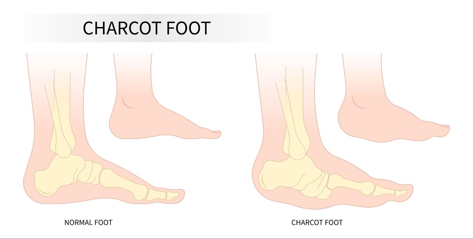 Charcot Foot Treatment | Dr Christy Graff | Adelaide