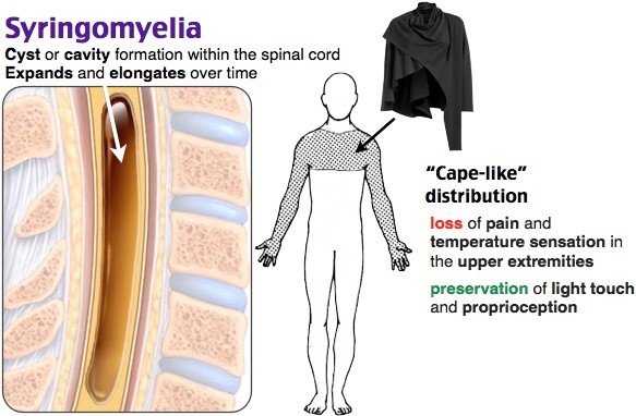 What is syringomyelia?