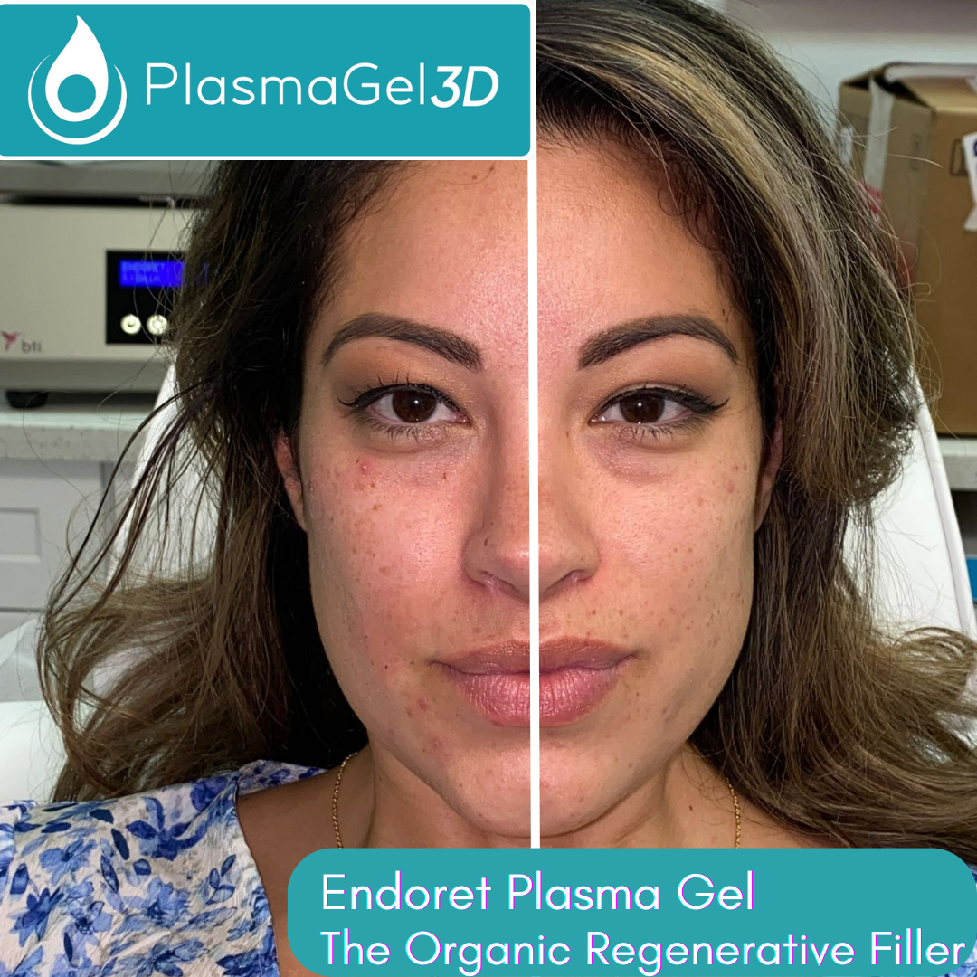 Plasma Gel Training | Esthetic Skin Institute