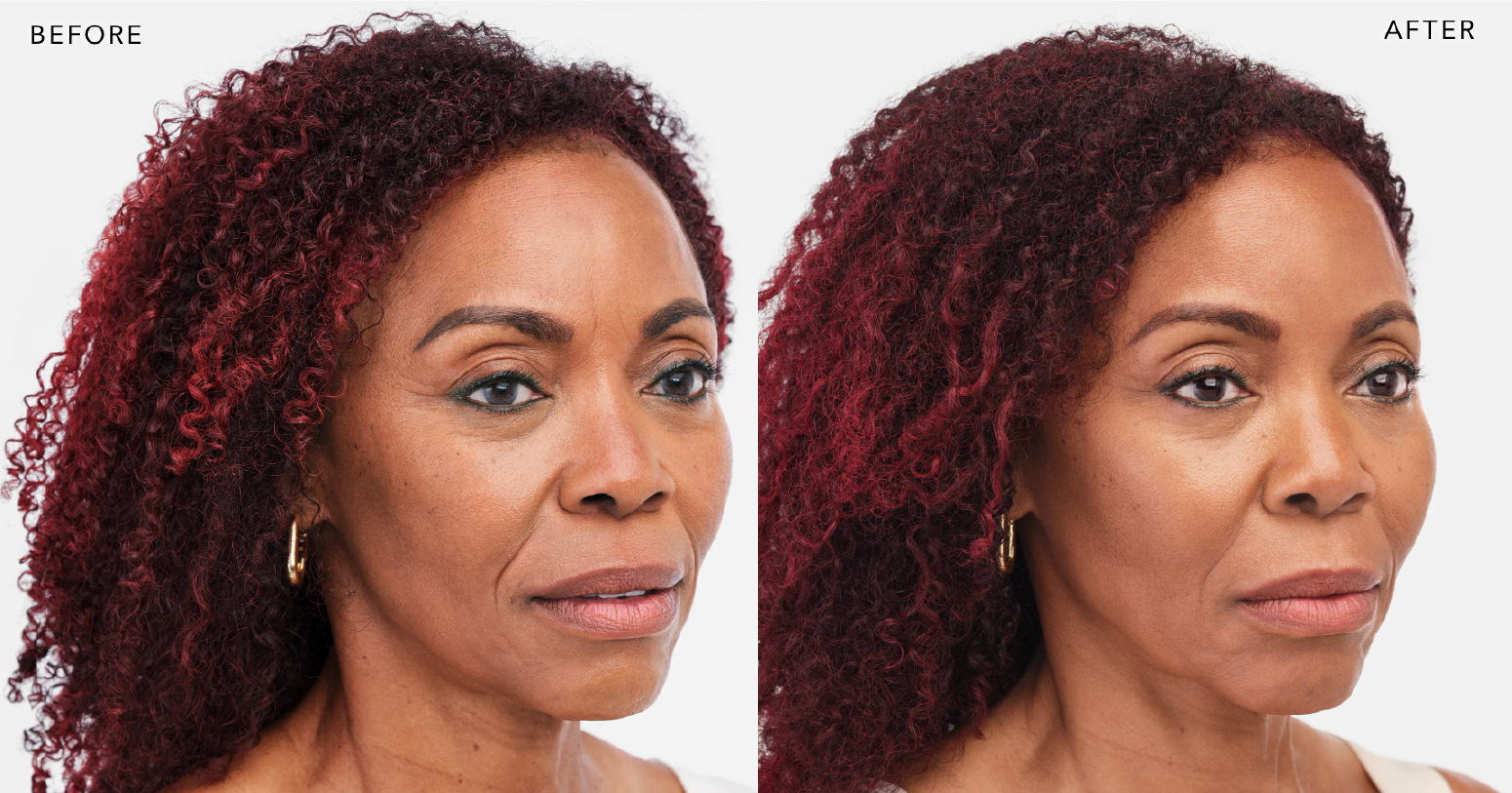 Radiesse Hyperdilute Training Esthetic Skin Institute Fl