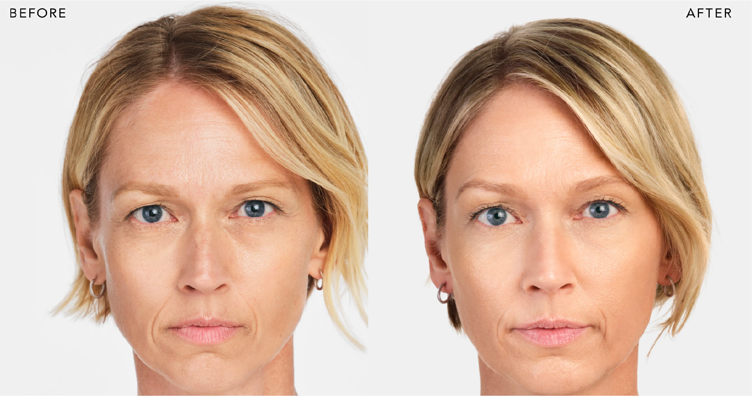 Radiesse Hyperdilute Training Esthetic Skin Institute Fl
