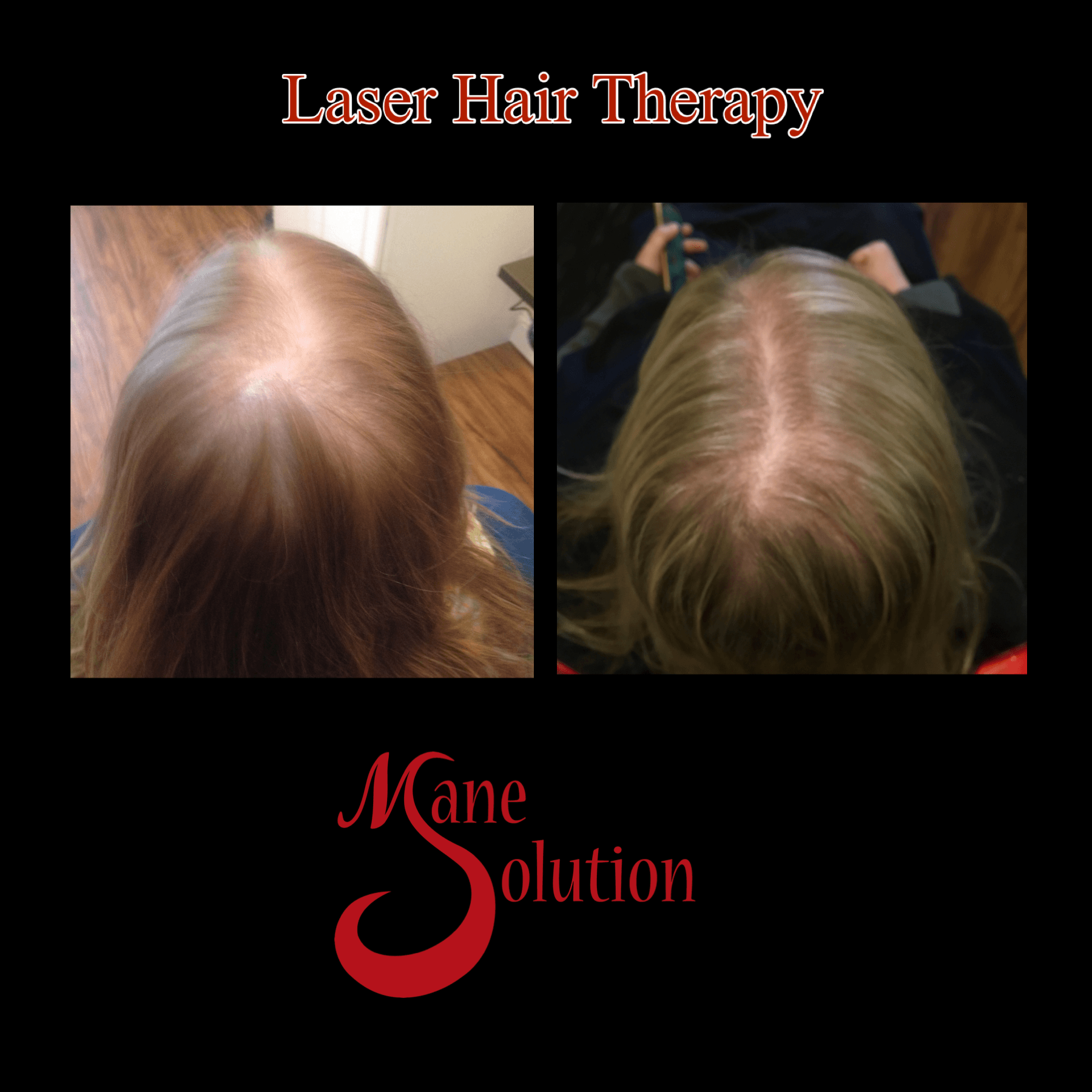 Hair Replacement & Hair Loss Treatment: Latham, NY | Mane Solution