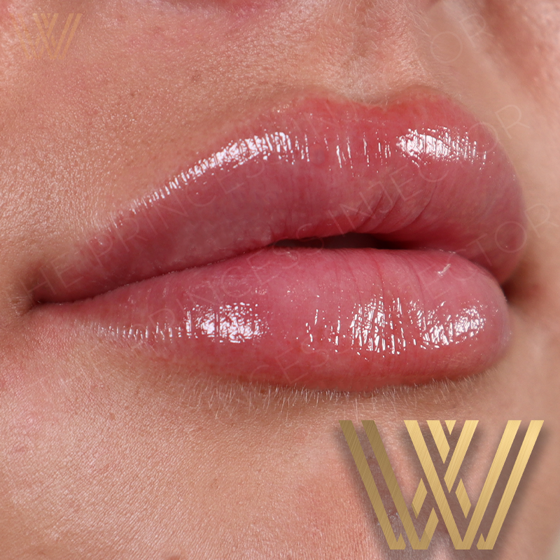 Exploring Lip Flips vs. Lip Fillers at Windermere Medical Spa