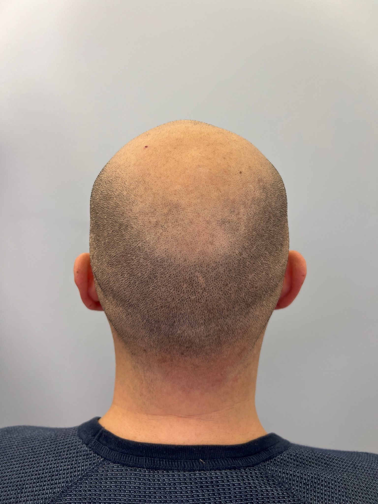 Scalp Scar Camouflage | Greensboro, NC | Scalp Micro Pro Clinic