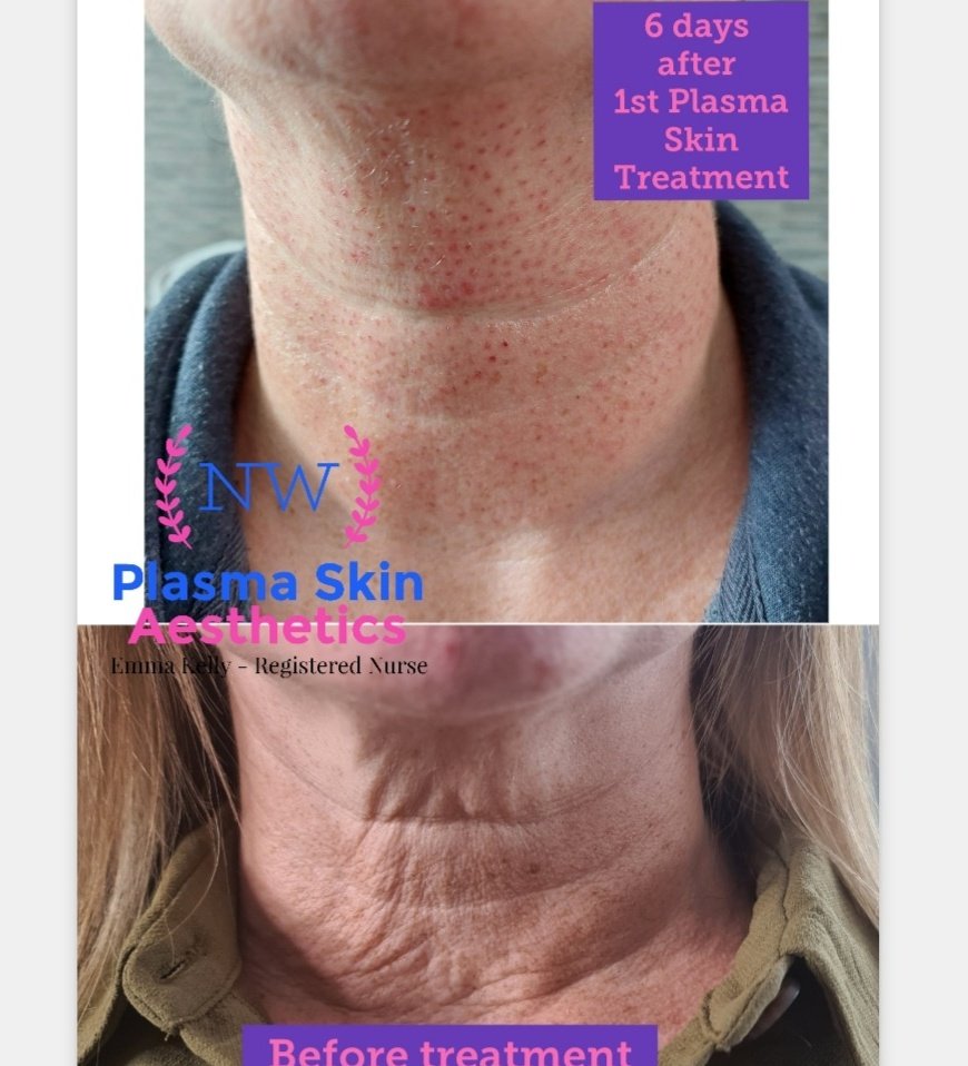 Plasma, Fibroblast Skin Tightening Treatment, Hair Loss