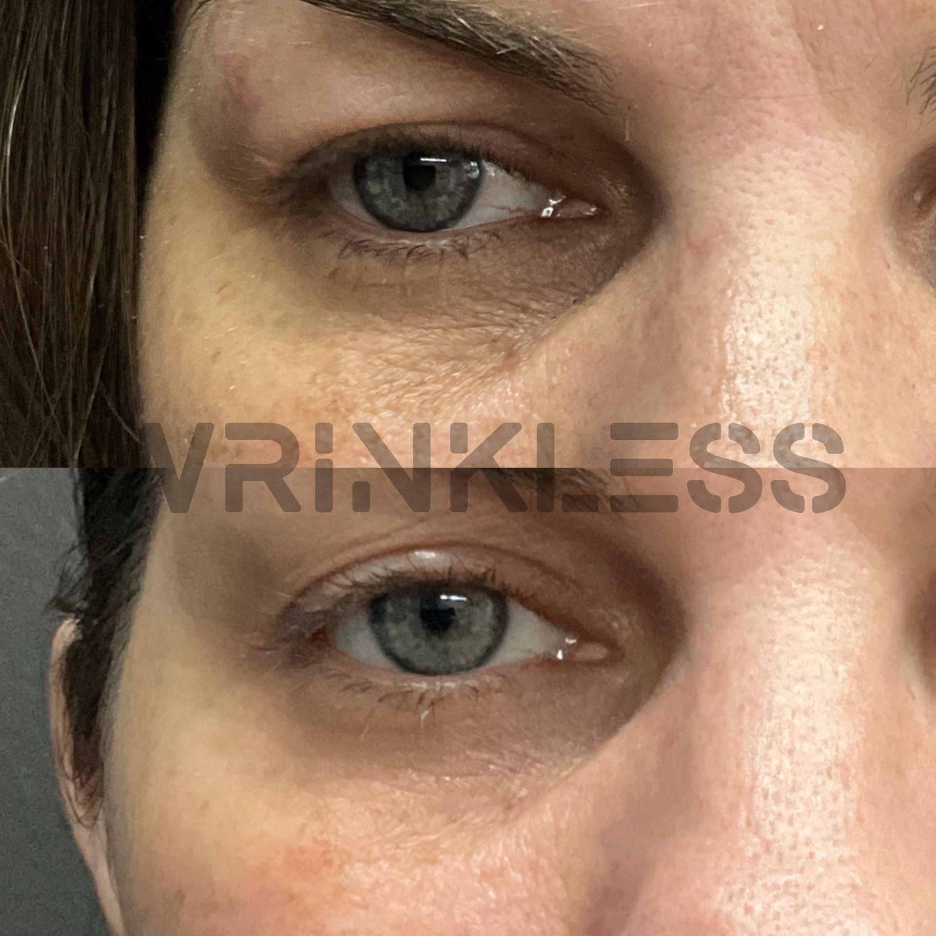 Polynucleotides Explained: Skin Regeneration & Benefits