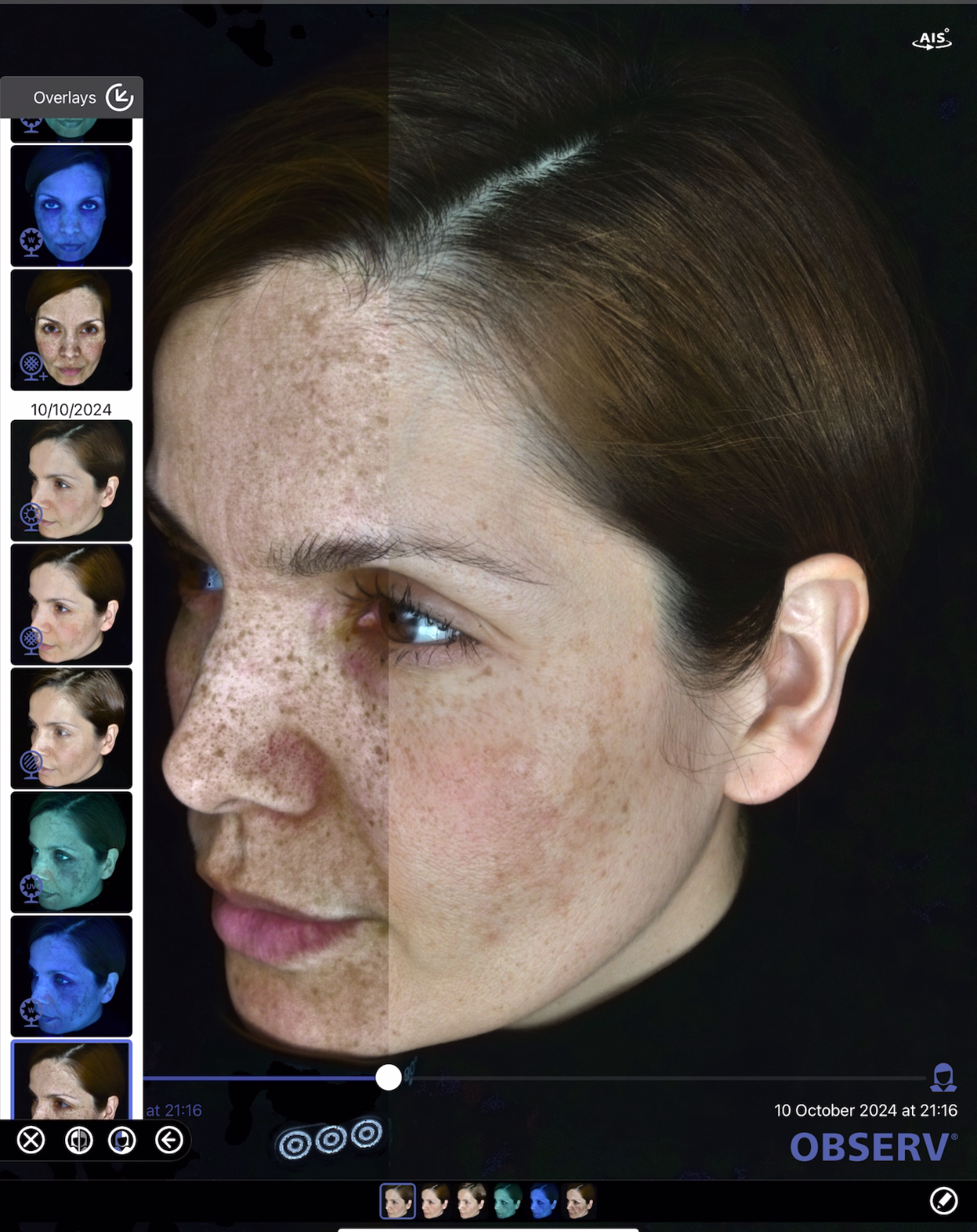 Unlock Radiant Skin with the Observ Scanner | Wrinkless Clinic