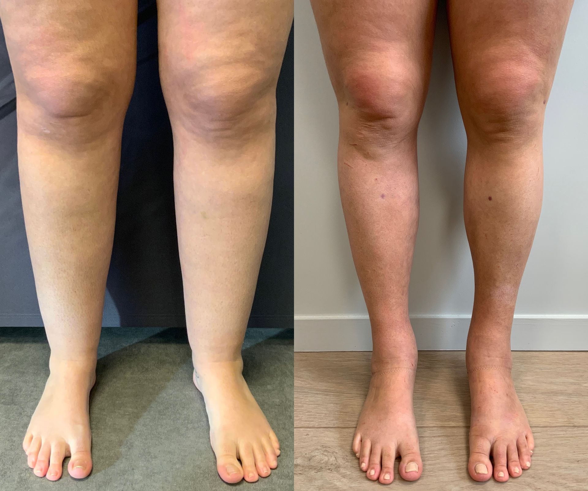 Le Guide Ultime du lipœdème : Le diagnostic et les soins