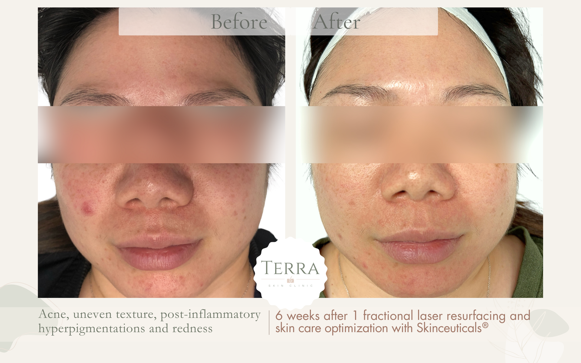 Post Inflammatory Hyperpigmentation | Markham, ON | Terra Skin Clinic