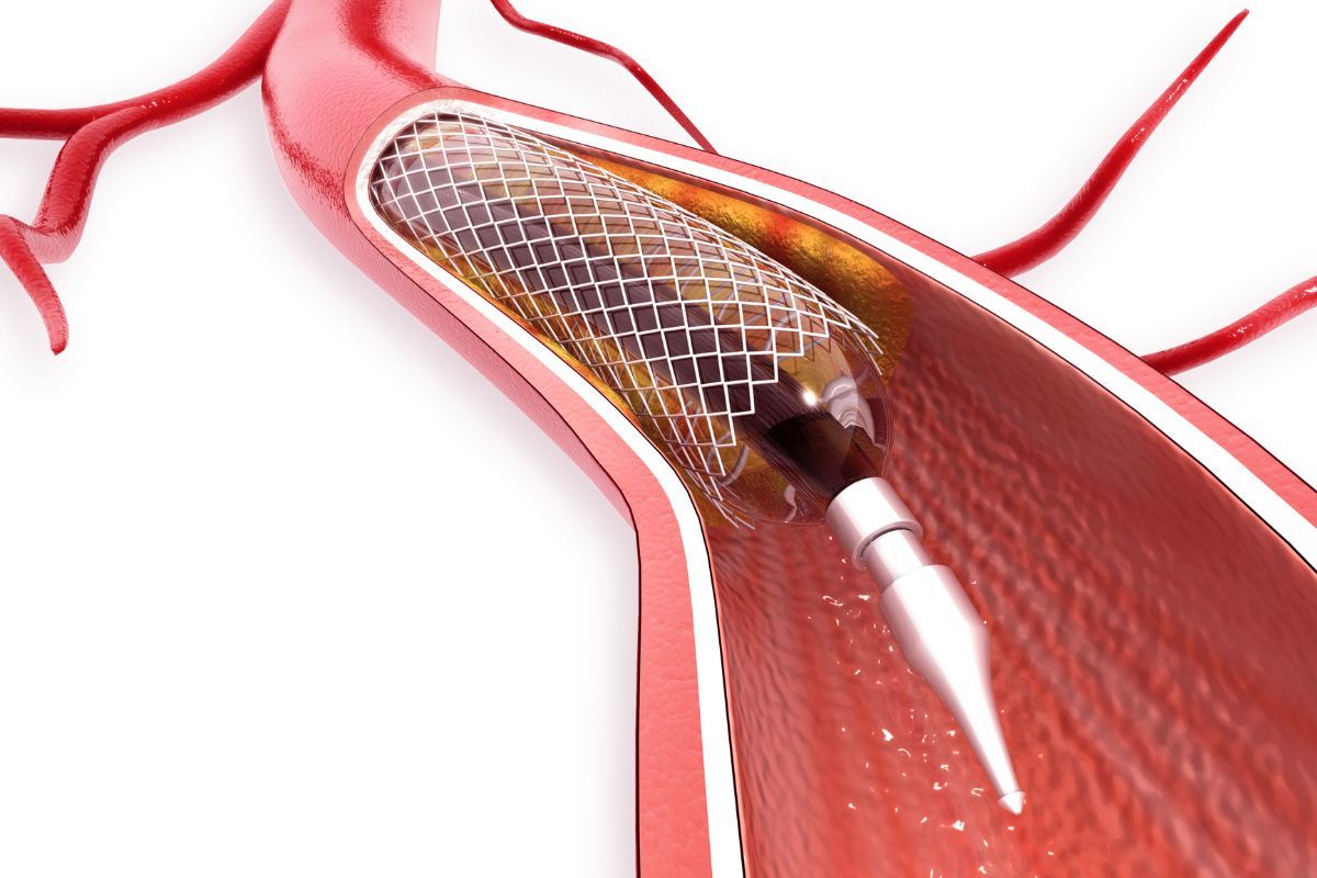 Stent: quando a colocação é necessária?