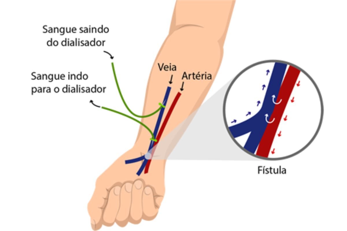 Fístula para hemodiálise: entenda