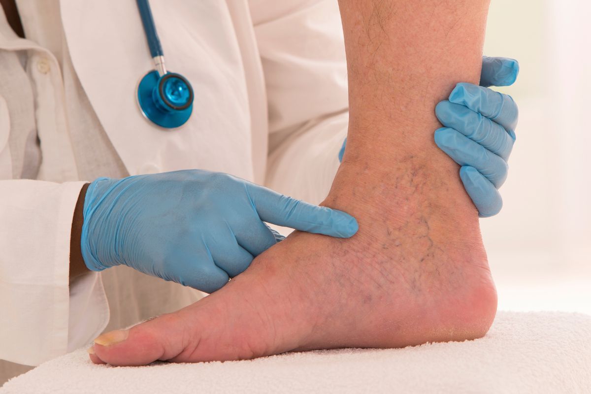 Tipos de varizes: conheça as diferenças