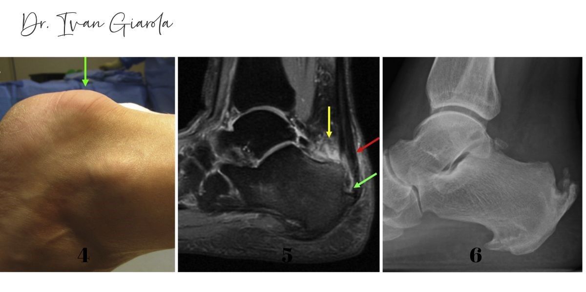 Tendinite do calcâneo: entenda