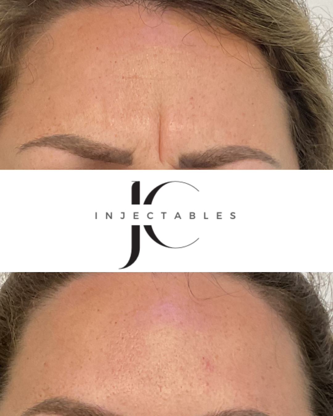 Anti-Wrinkle Treatments | JC Injectables | Auckland