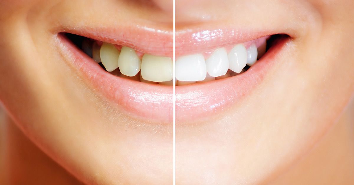 What Is the Best Way to Achieve Pearly White Teeth?