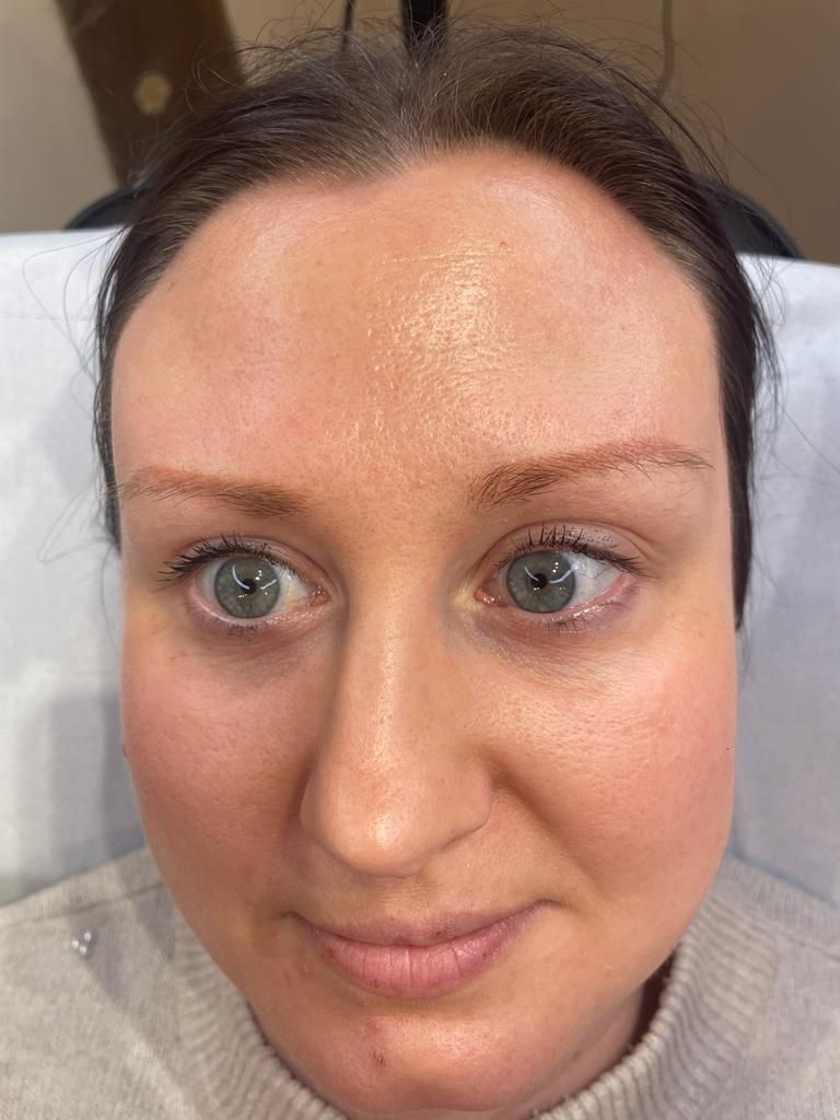 Anti-Wrinkle Injections York | | Michelle Orman Aesthetics