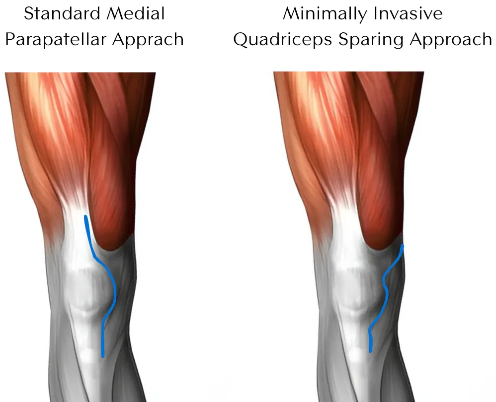 Knee Joint Replacement | Canberra, Bega & South NSW | Dr Rajesh