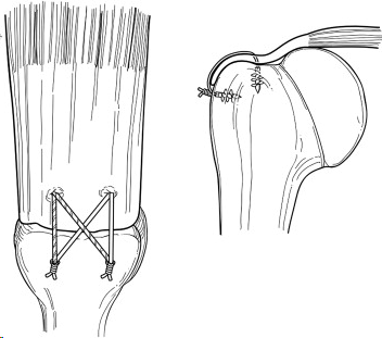 Gluteus Tendon Tear | Canberra, Bega & South NSW | Dr Rajesh
