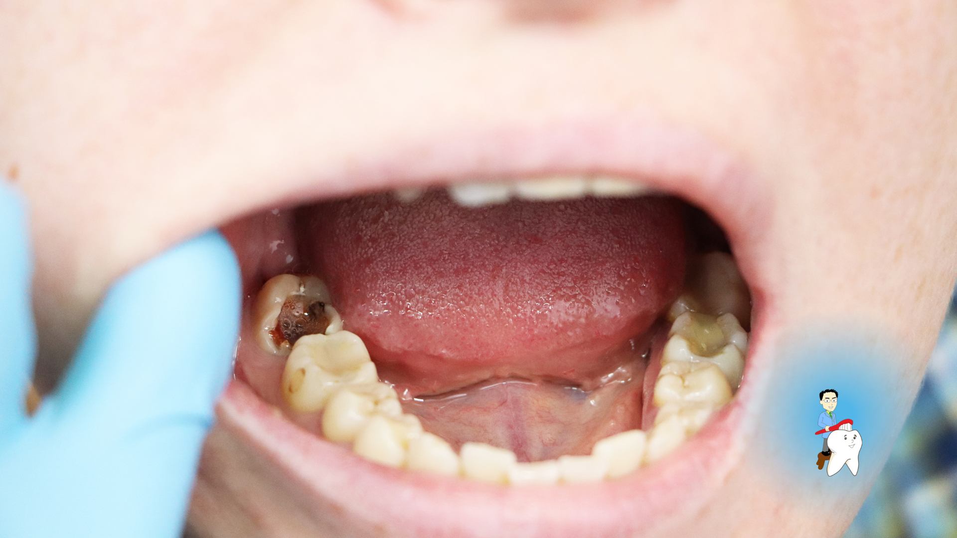 White Spots on Kids’ Teeth: Signs of Decay or Fluorosis?