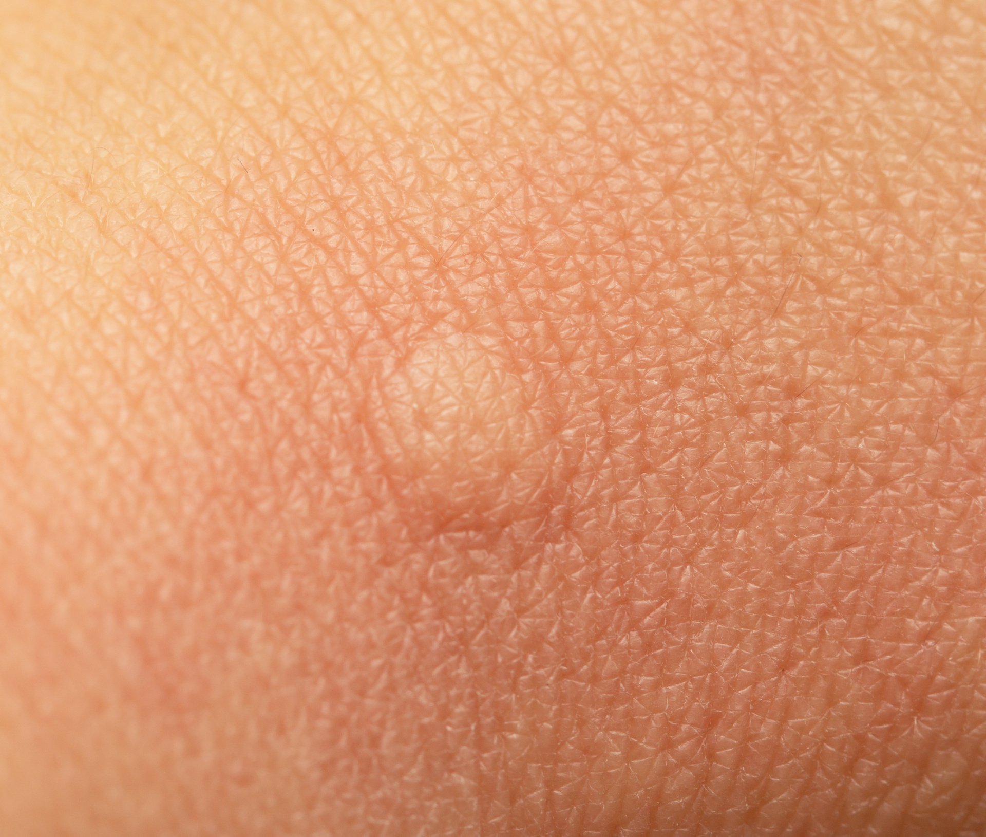 Difference Between Bed Bug Bites Vs Mosquito Bites Ecoguard