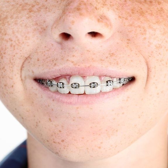 Braces from Zambrano Ortho | Braces and Invisalign | Miami