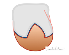 Goldilocks Mastectomy