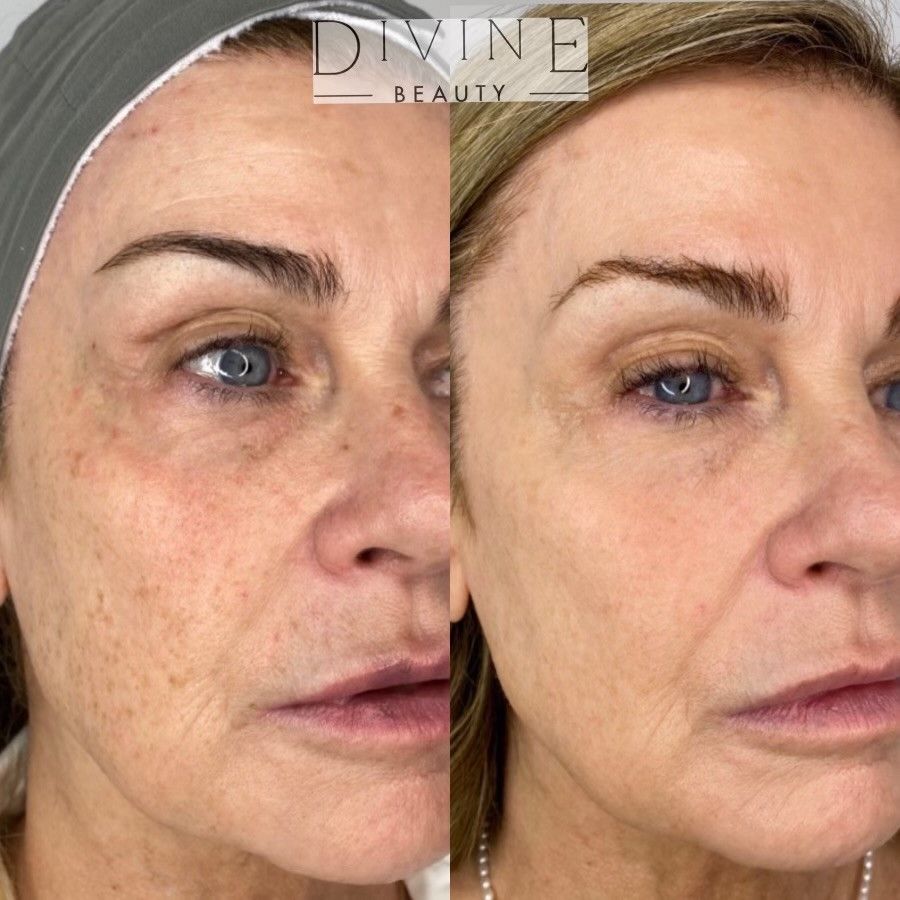 PDO AfterGlo™ Skin Booster