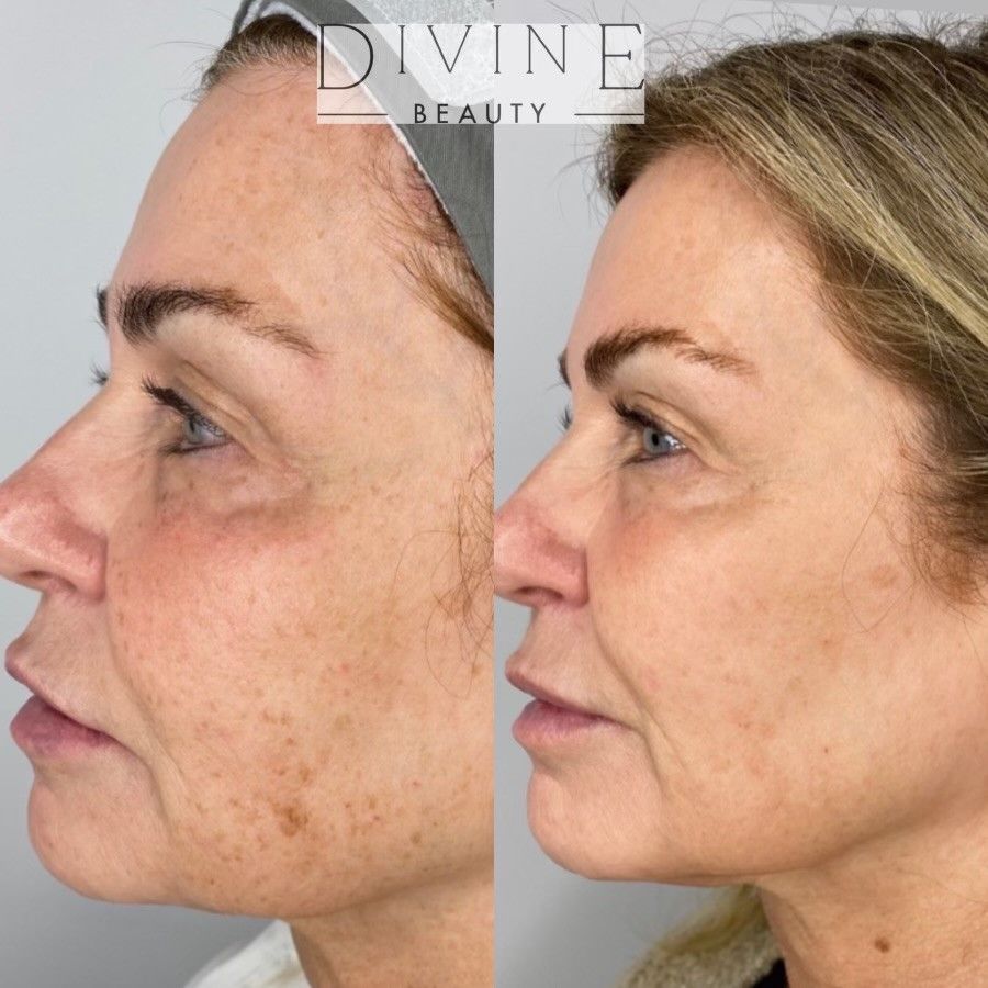 PDO AfterGlo™ Skin Booster