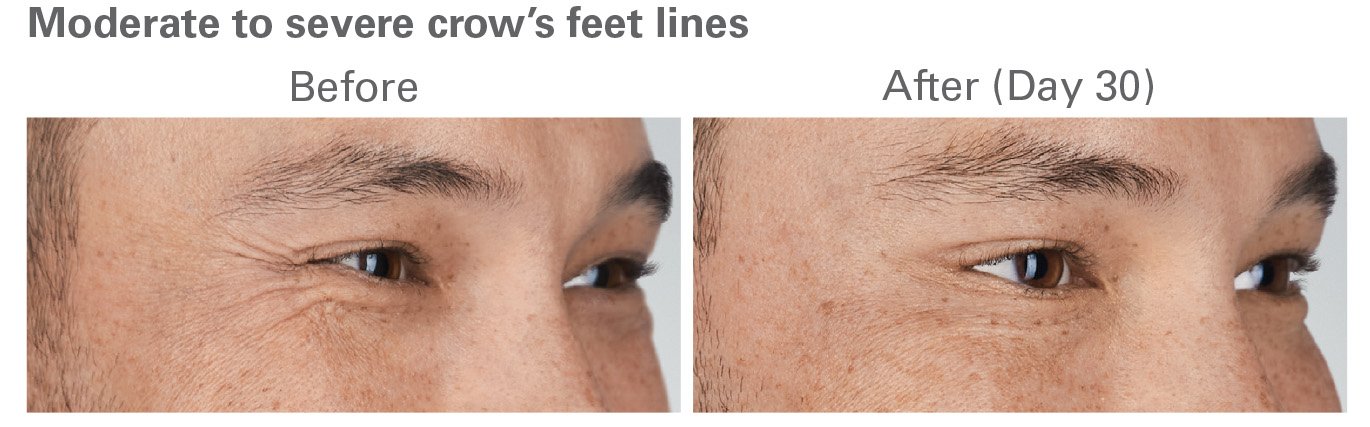 Botox & Dysport Injections in Houston | Bounce Hydration