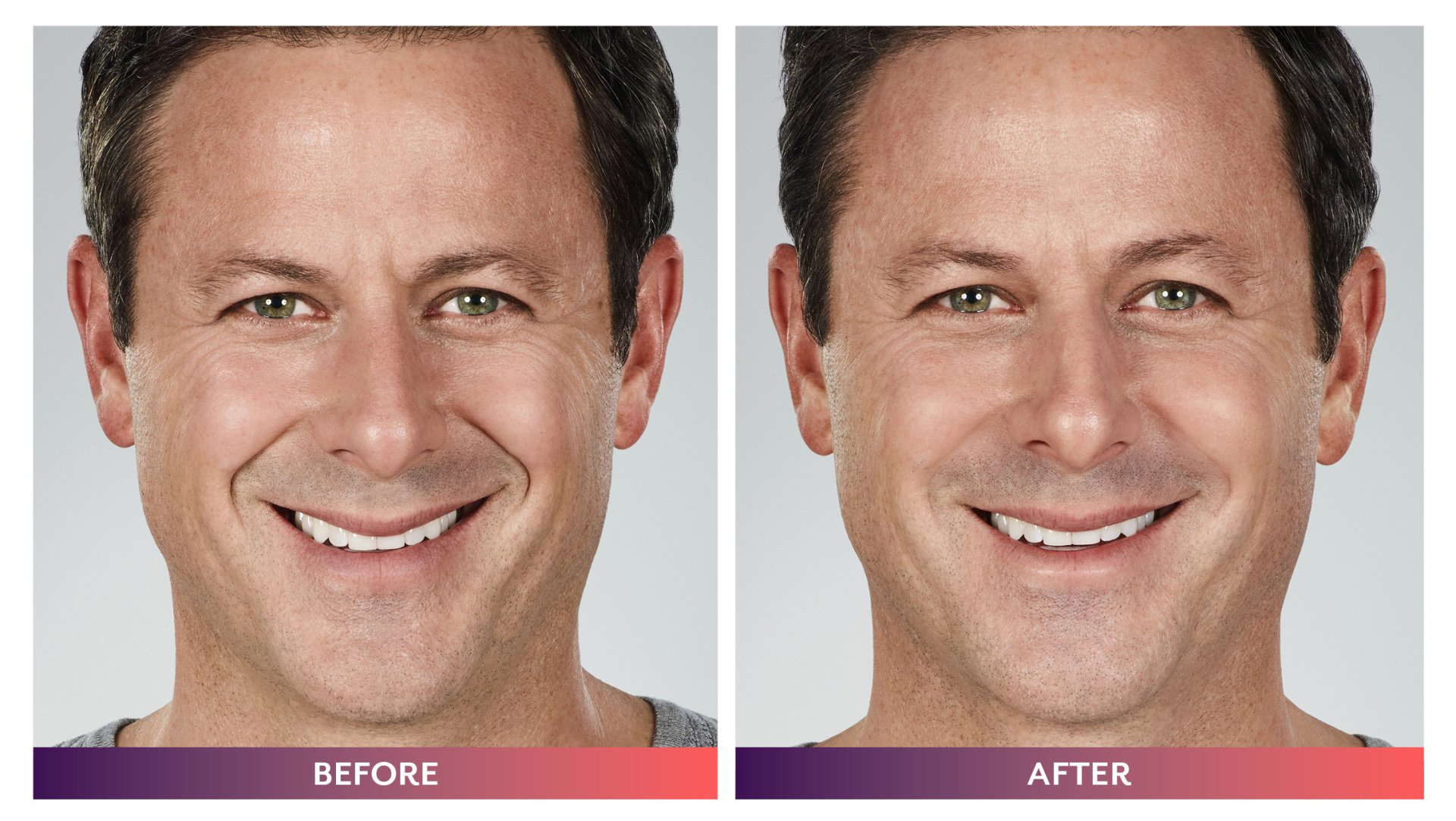 Juvederm Facial Fillers in Houston | Bounce Hydration