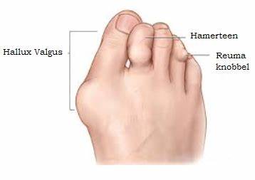 Pedicurepraktijk Bernadette in Reuver | Home