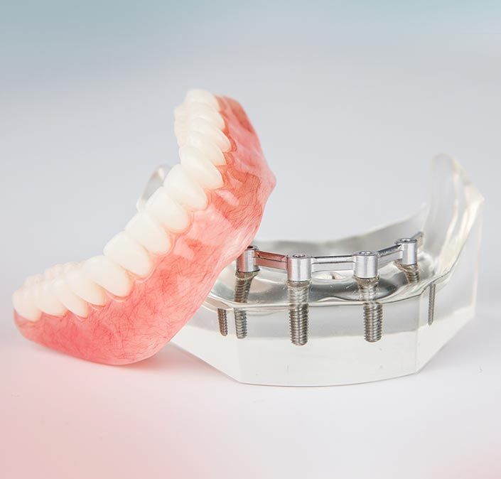 Implant Retained Dentures Near Sarina | Cosmetic Denture Services