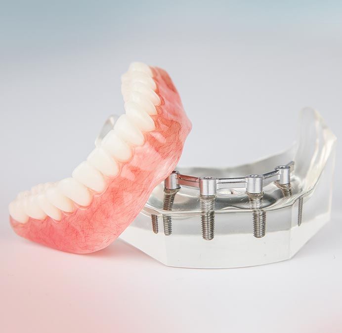 Implant Retained Dentures Near Moranbah | Cosmetic Denture Services
