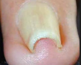 Ingrown Toenail Treatment | Treatments | Eastpoint Podiatry, Edgecliff NSW