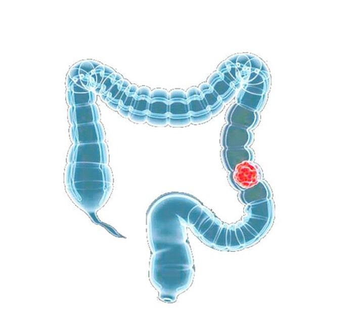 Cirugía de Colon en Querétaro - Dr. Miguel Luis Esquivel Herrera