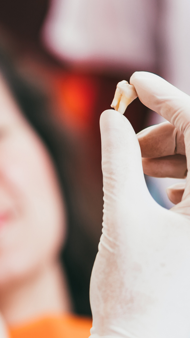 When Can I Eat Solid Food After a Tooth Extraction?