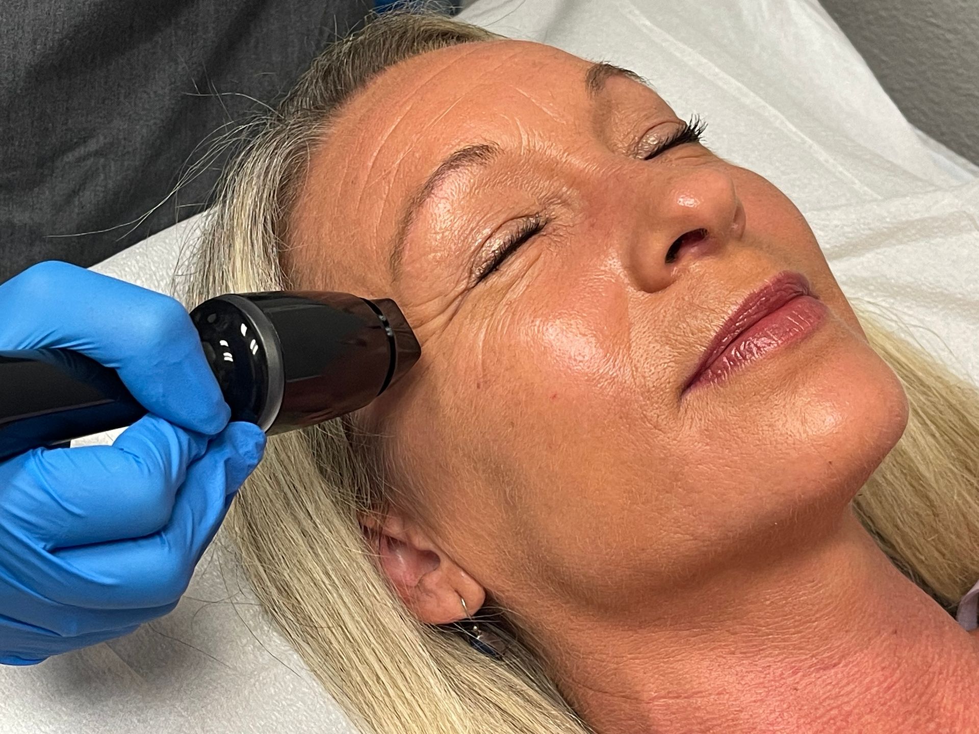 Radiofrequency Microneedling | St Augustine FL