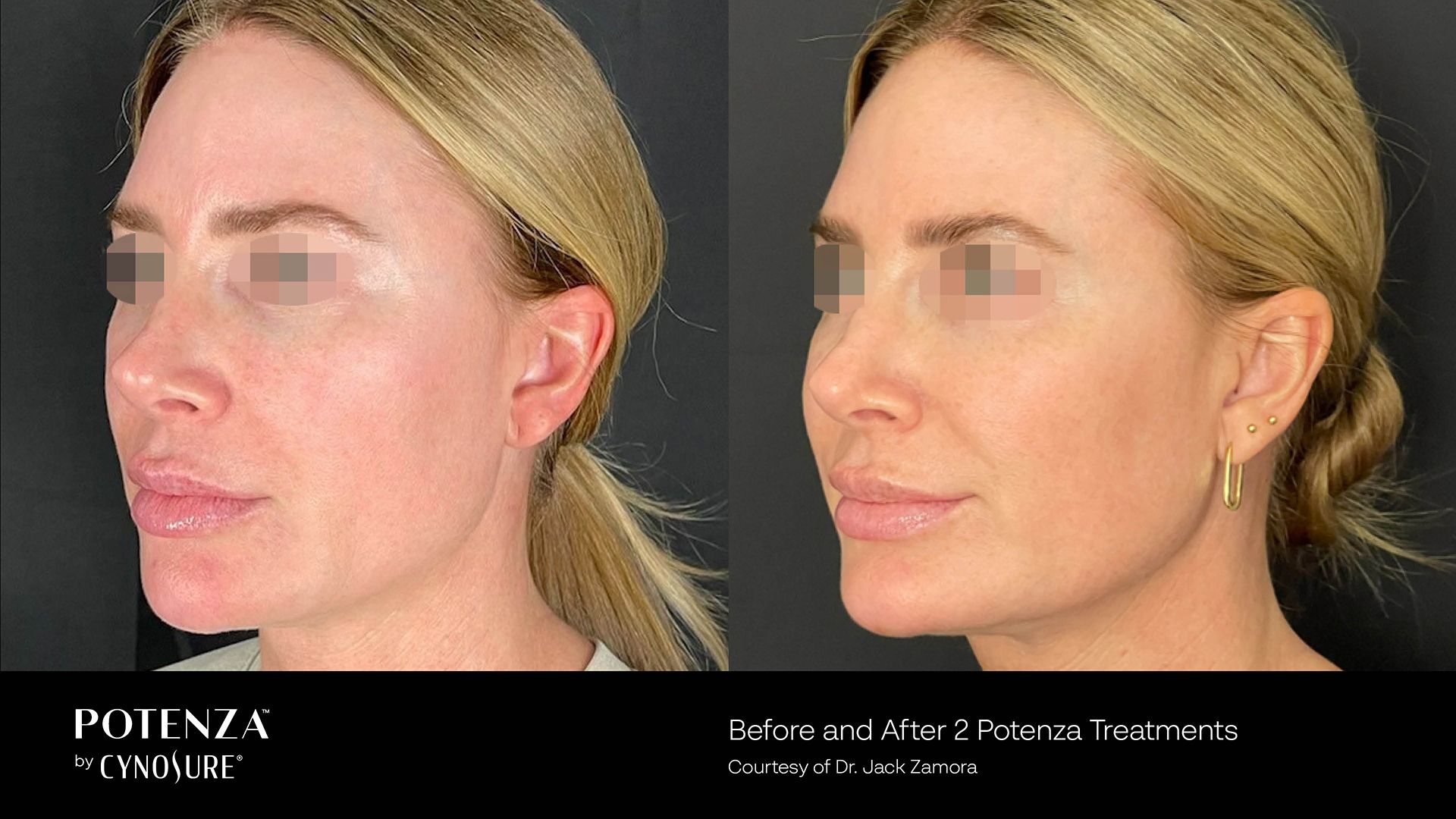Potenza Microneedling | Lifeways Integrative Wellness