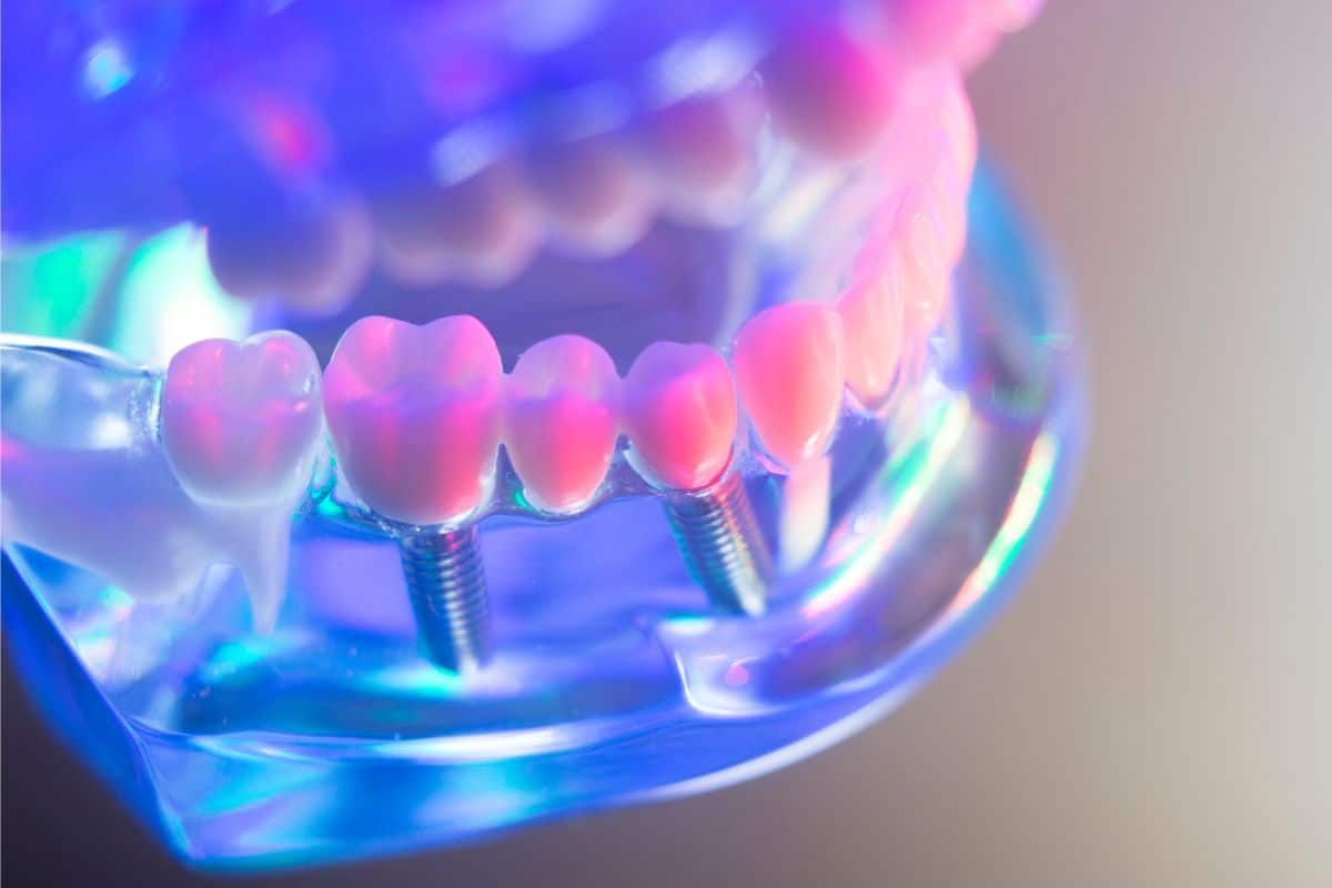 Are Dental Implants as Strong as Natural Teeth? | Vegas Tooth Dr