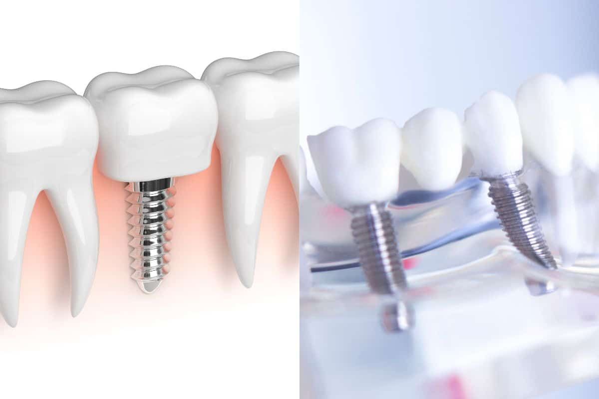 Single vs. Multiple Teeth Replacement | Henderson Dental Implants