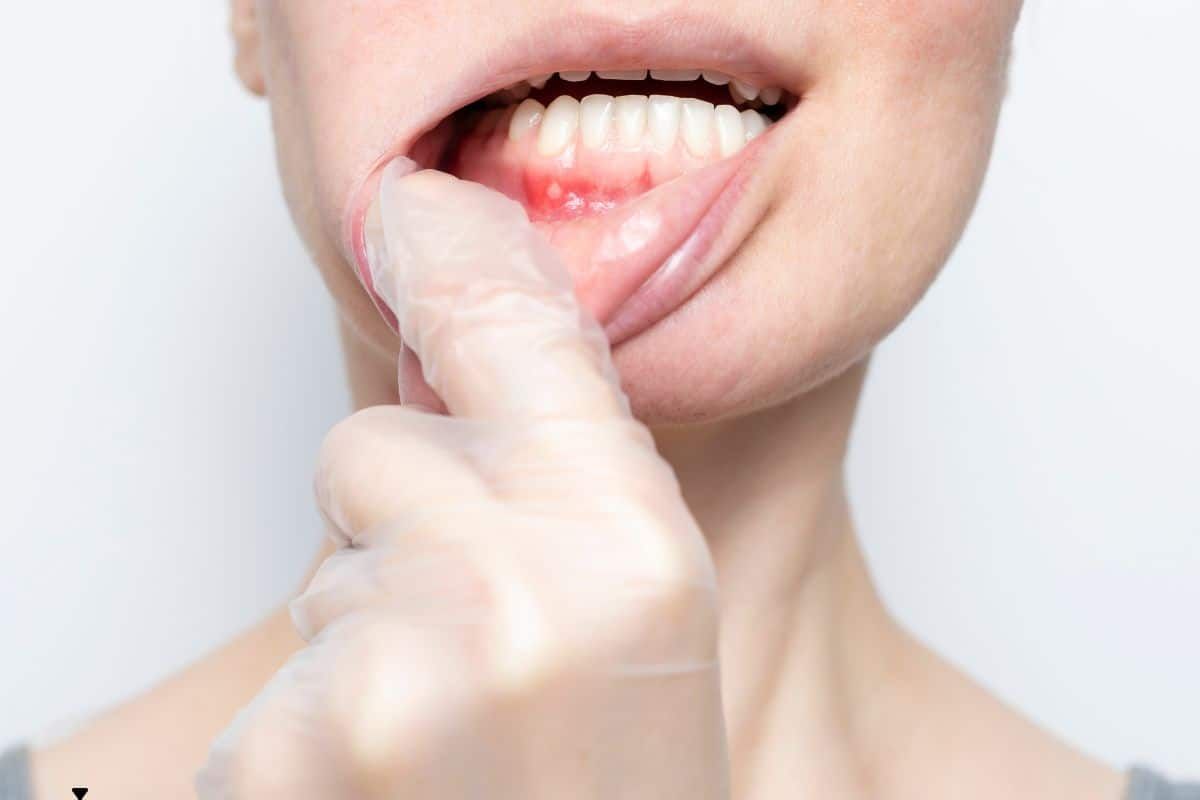 What Foods to Avoid for Canker Sore Relief?