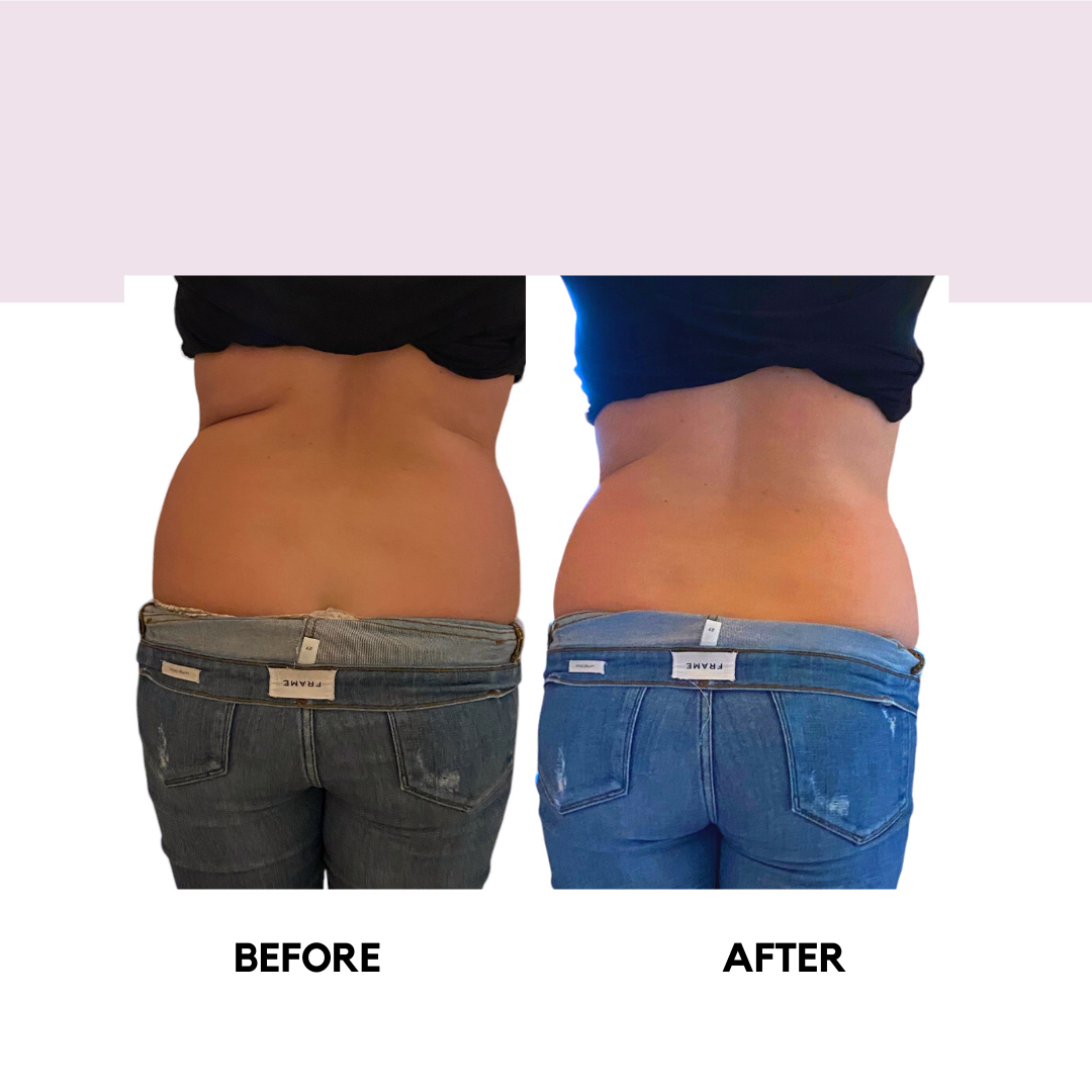 Beach City Body Contouring