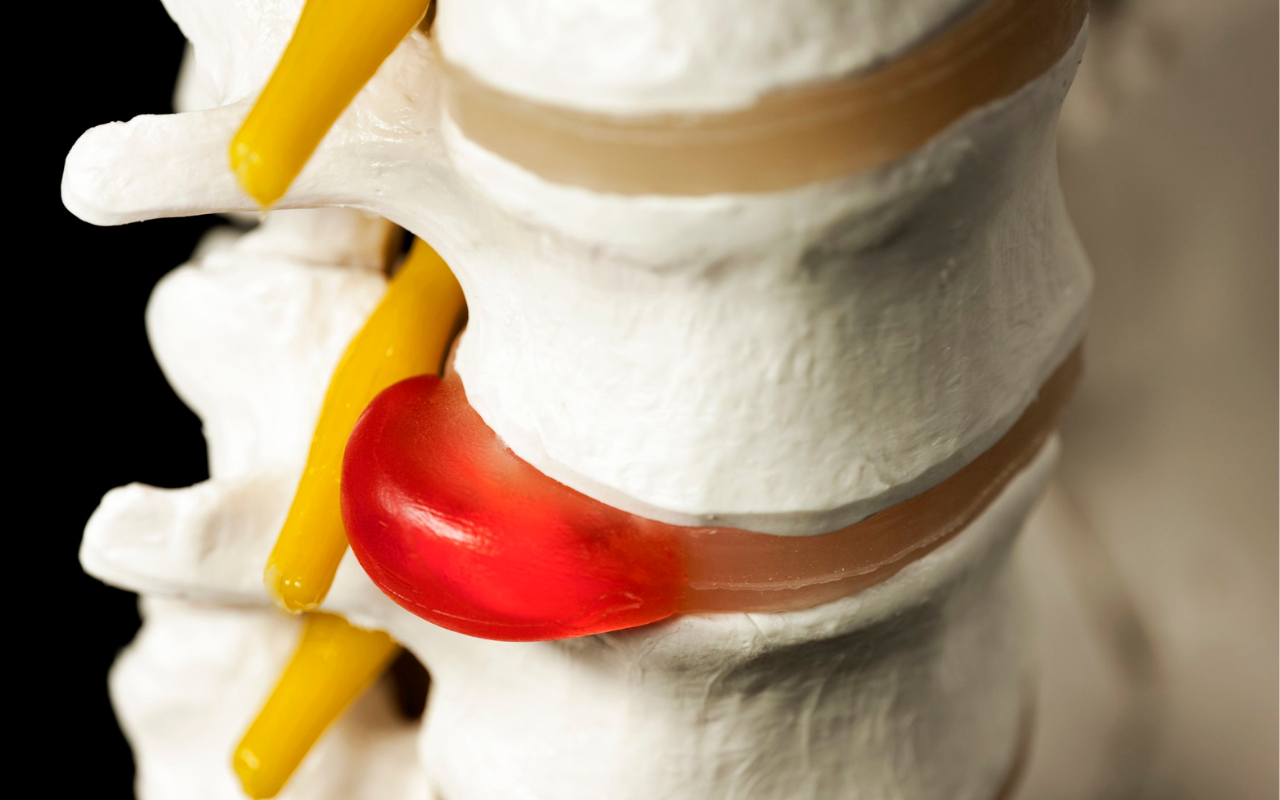 What Are Bulging Discs and How Does Massage Help?