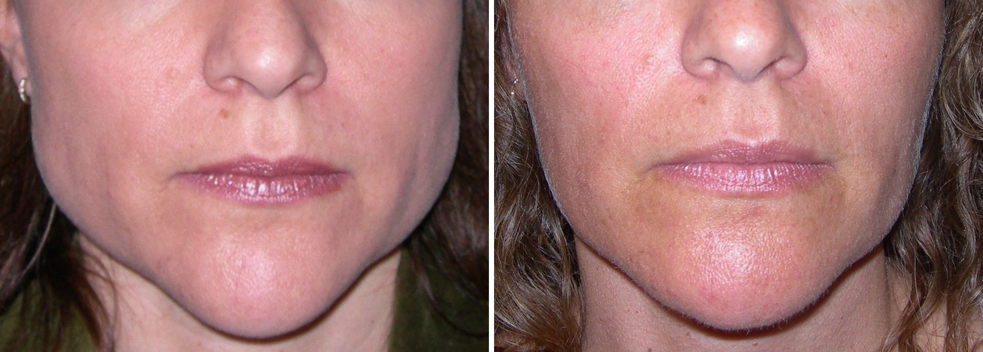 Botox for Zygomatic Muscles (Masseter/Temporalis) Cost in Korea
