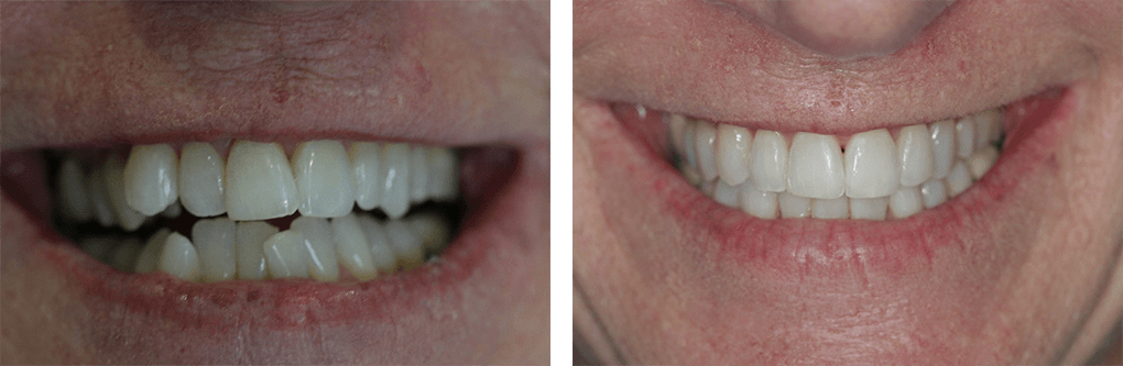 6 Month Smiles, Cosmetic Treatments in Newark and Bear