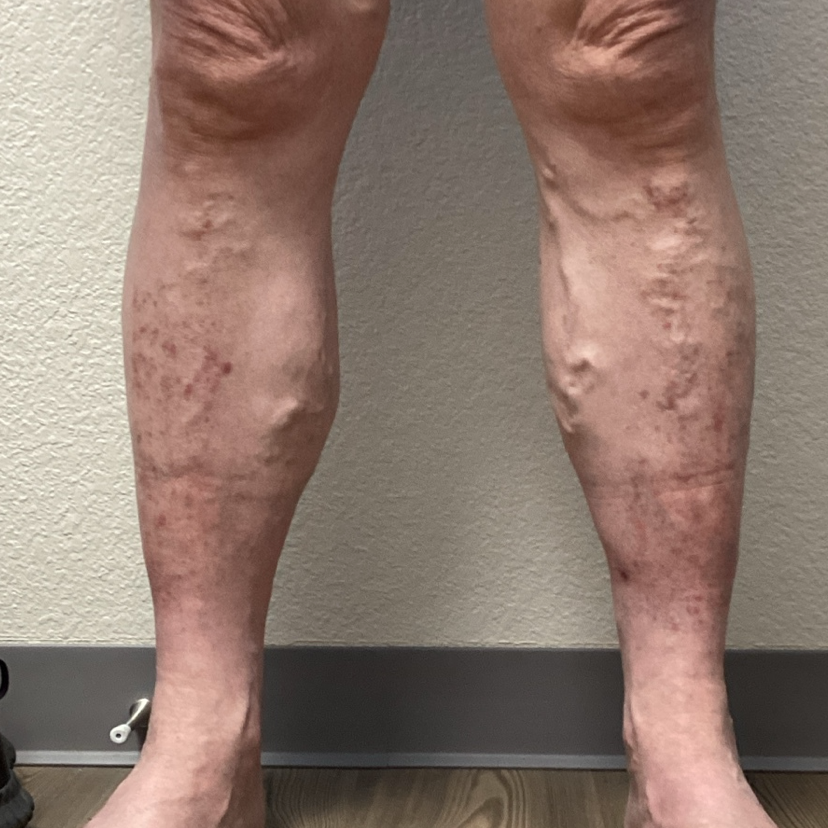 Alaska Vein Care | Alaska's Premier Varicose Vein Specialists