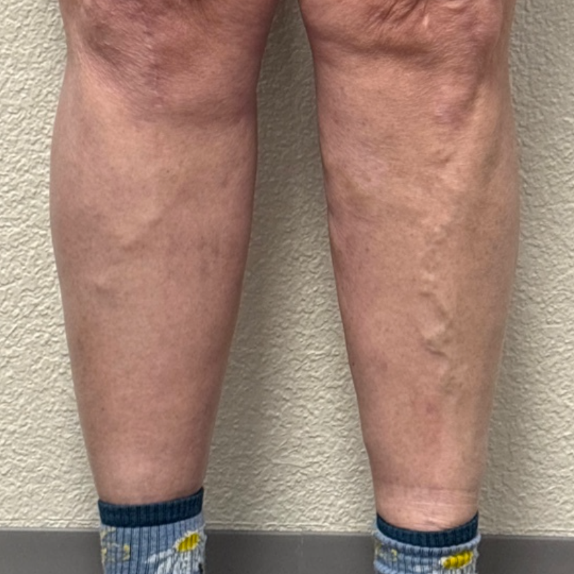 Alaska's Premier Center For Varicose Vein Treatment