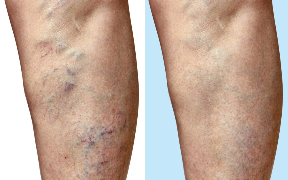 Varicose Veins vs. Spider Veins: Understanding the Differences