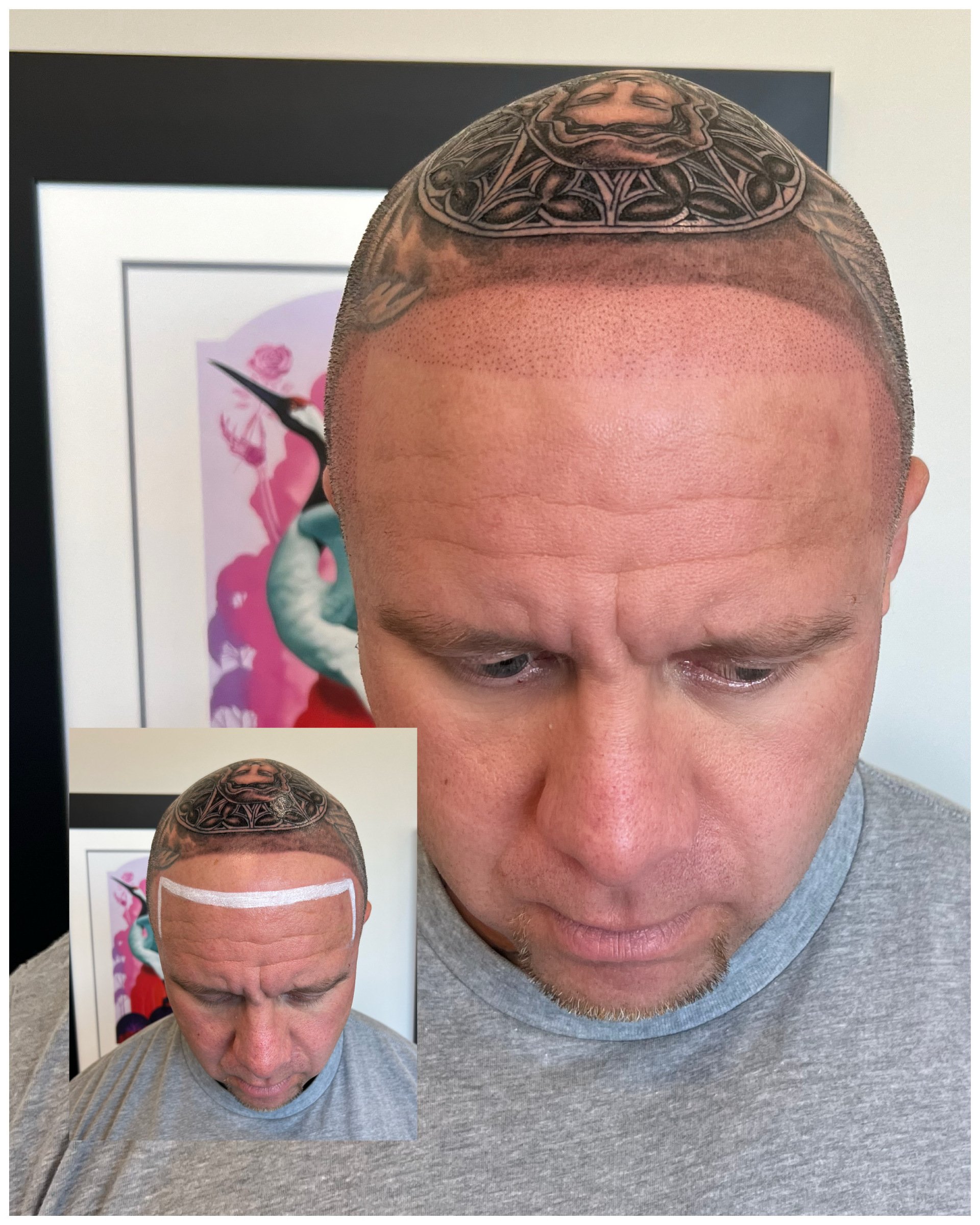 Before and After SMP Scalp micropigmentation