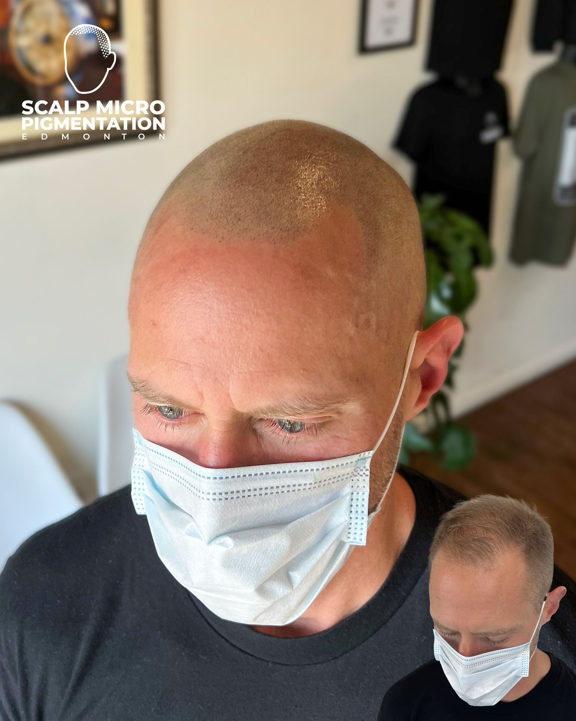 Male Client M70 | Scalp Micro Pigmentation Edmonton SMP